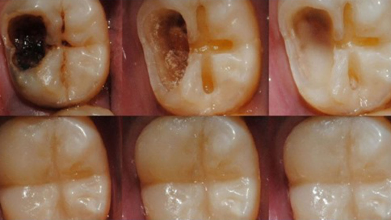 New Treatment Makes Teeth Grow Back : The Premier Daily