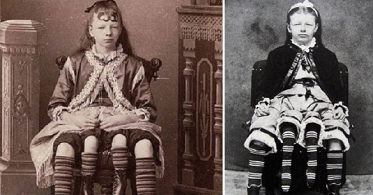 Myrtle Corbin Was A Four Legged Woman Who Had Five Kids Of Her Own