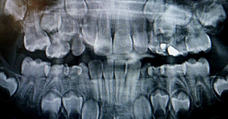 Doctors Found 526 Teeth in Mouth of a 7-Year-Old Boy