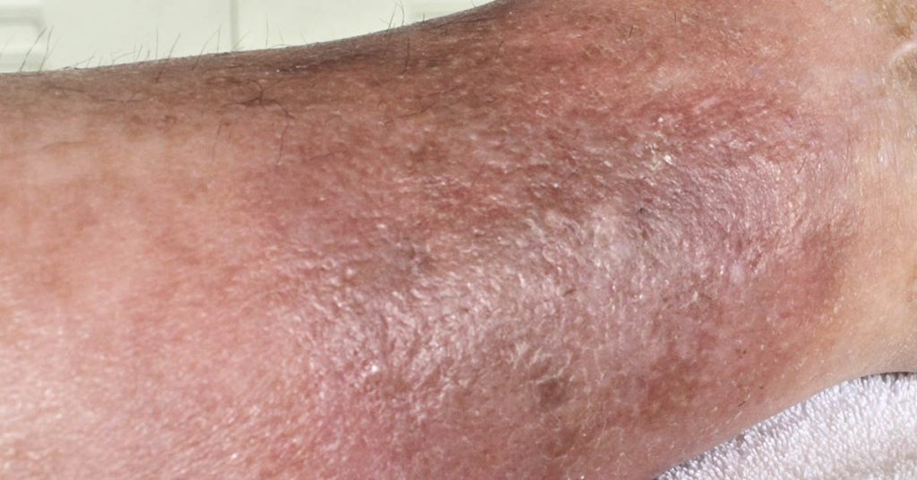 Olympian Develops ‘Play-Doh’ Legs Due to Cellulitis Infection