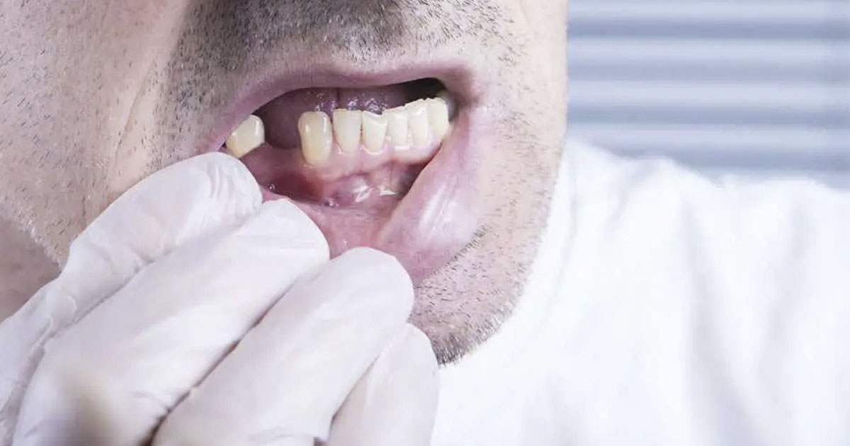 Drug Therapy for Tooth Regeneration is Set for Human Clinical Trials ...