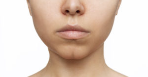 What are Chin Dimples?