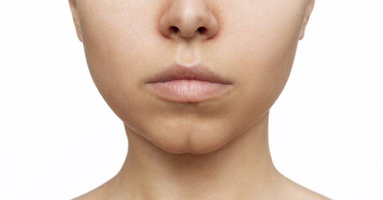 What are Chin Dimples?